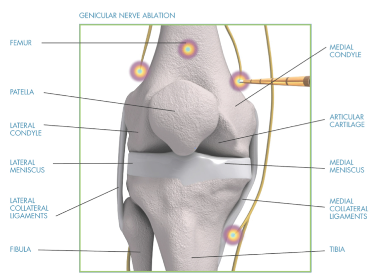 Genicular Neurotomy – Northern Pain Centre